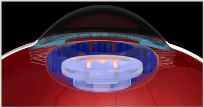 Shape-Changing Accommodating IOL Shows Promise in Clinical Trials ...
