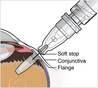 US FDA Approves Genentech’s Susvimo Refillable Implant for DR | Market ...