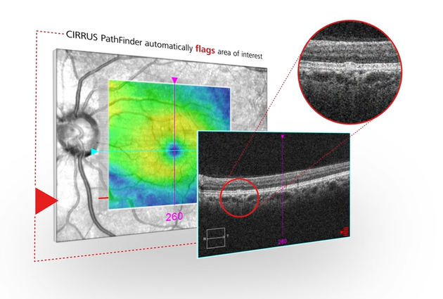 Zeiss Gains CE Marking for Cirrus PathFinder AI Tool With Automated OCT ...