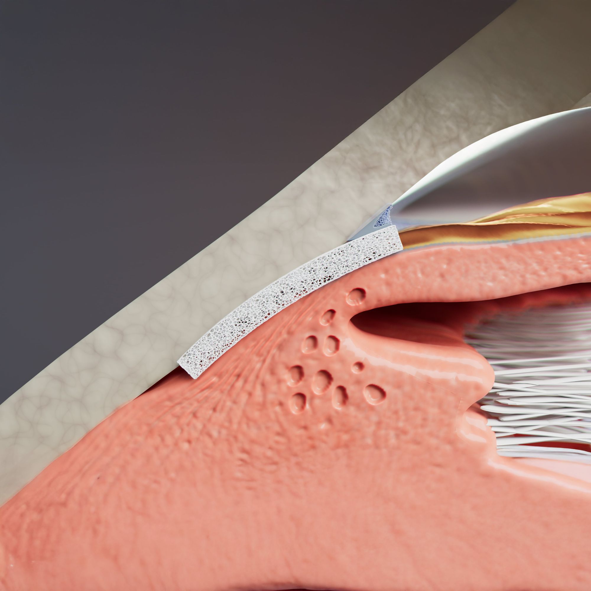 Iantrek Announces US Commercial Launch of AlloFlo Uveo Biostent for ...